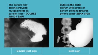 Double Track Sign Pyloric Stenosis