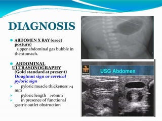 Infantile hypertropic pyloric stenosis.pptx