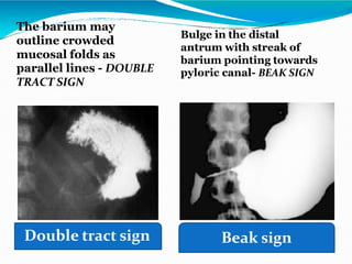 Infantile hypertropic pyloric stenosis.pptx