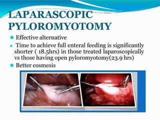 Infantile hypertropic pyloric stenosis.pptx