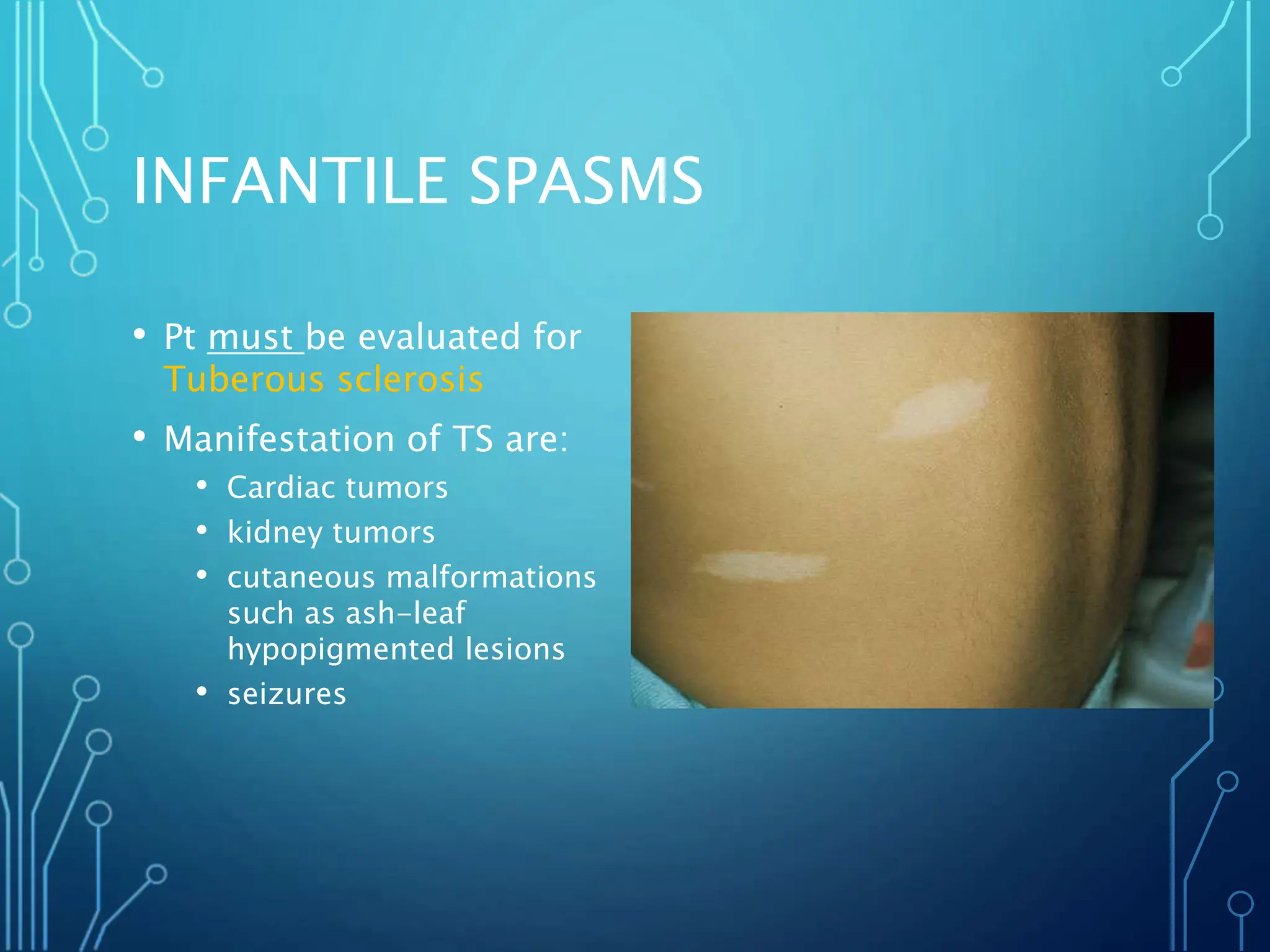 Infantile Spasms.ppt