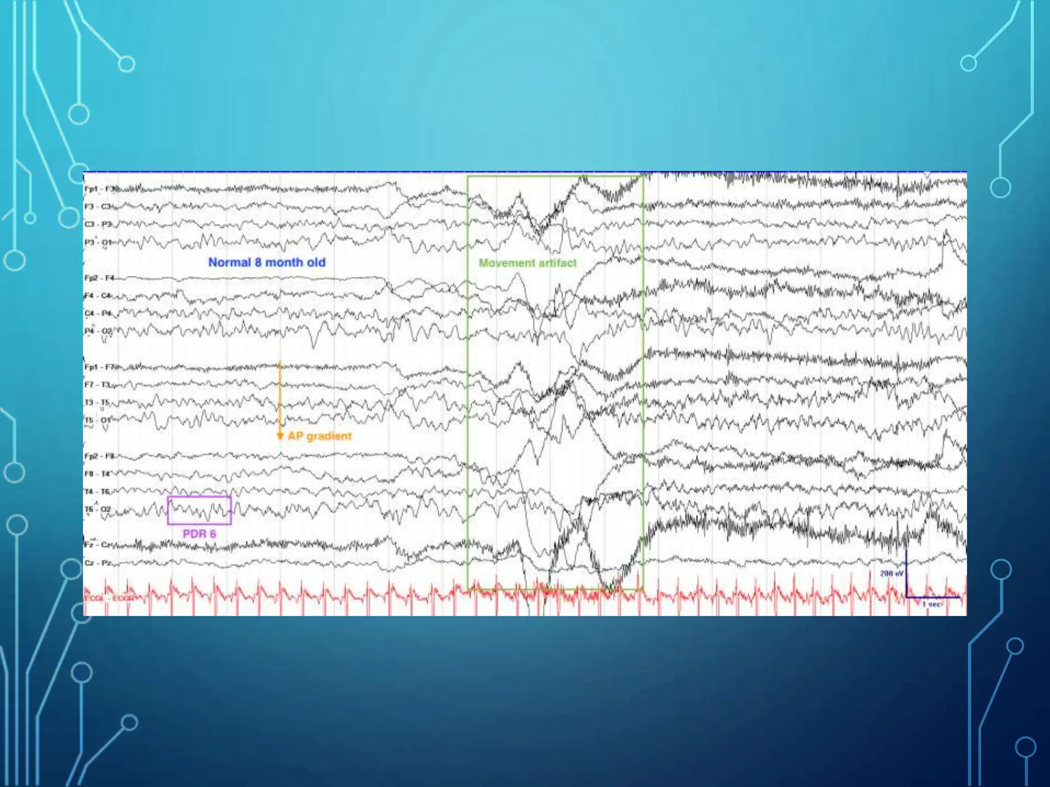 Infantile Spasms.ppt