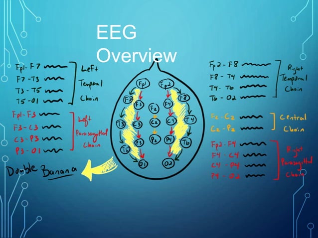 Infantile Spasms.ppt | Brain and Nervous System Disorders | Diseases ...