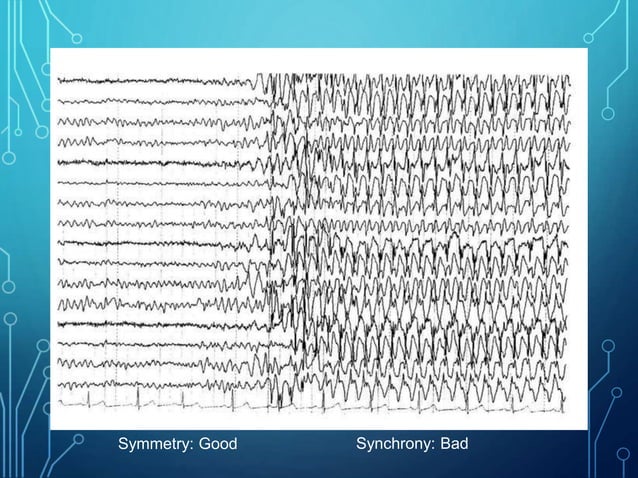 Infantile Spasms.ppt | Brain and Nervous System Disorders | Diseases ...
