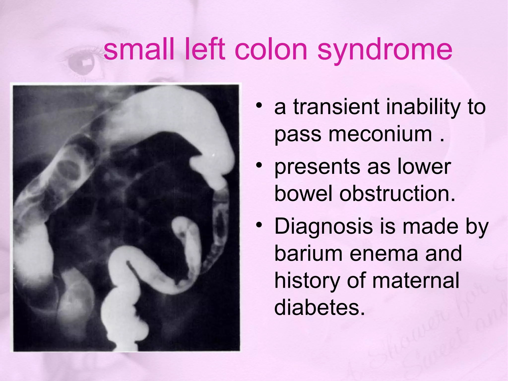 Infant of a diabetic mother | PPT