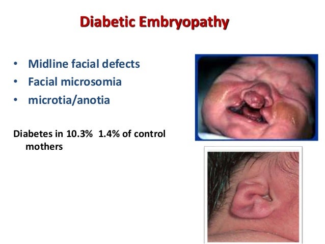 Infant of diabetic mother