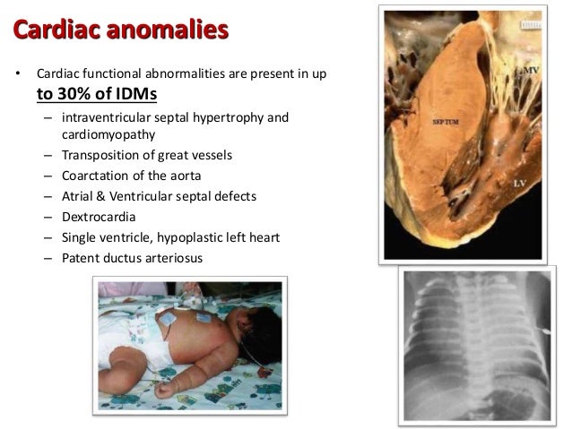 Infant of diabetic mother