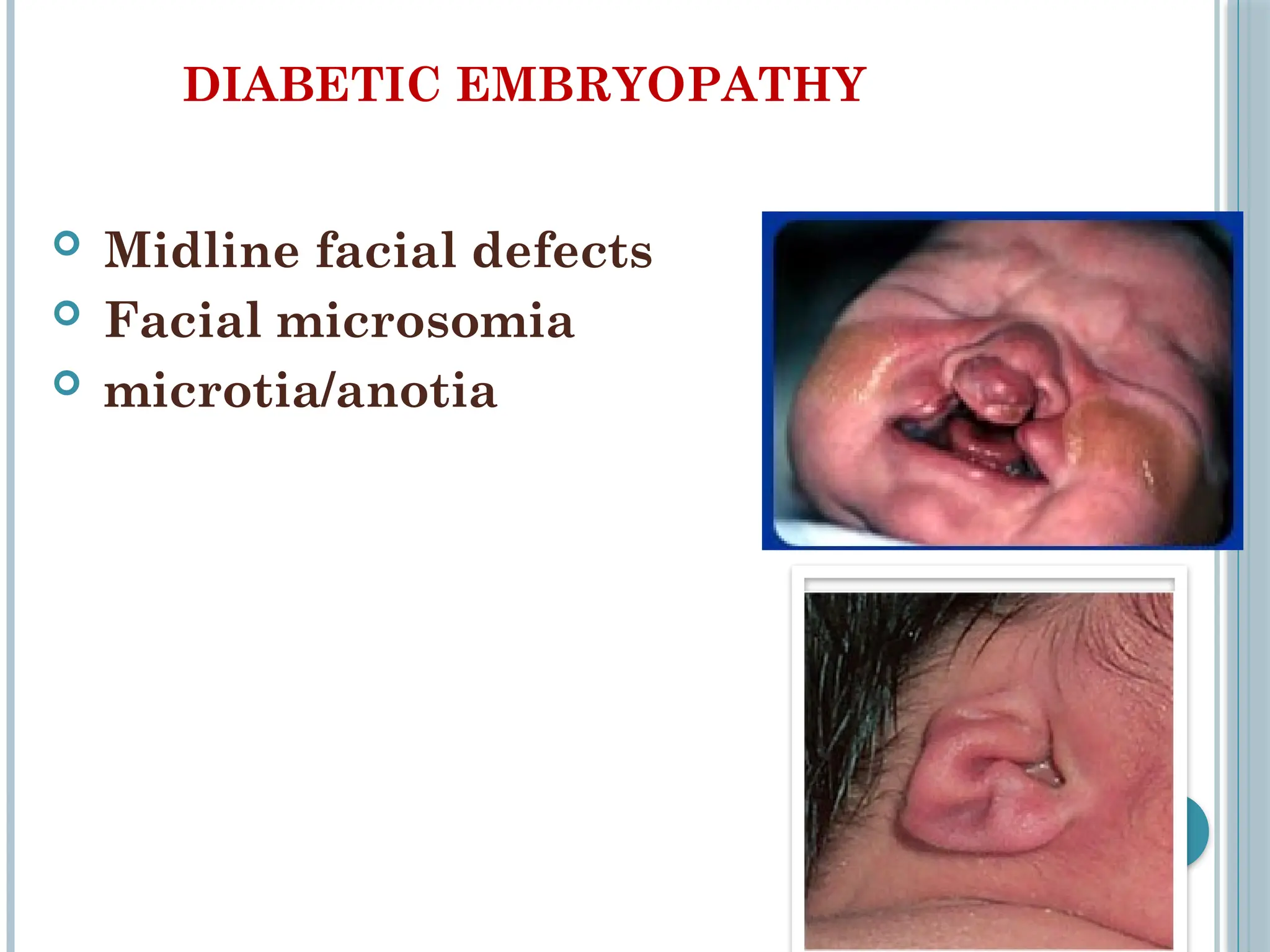 INFANT OF DIABETIC MOTHER copyslides.pptx | Pregnancy | Reproductive Health