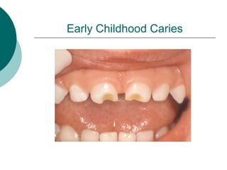 Infant oral health care program | PPT