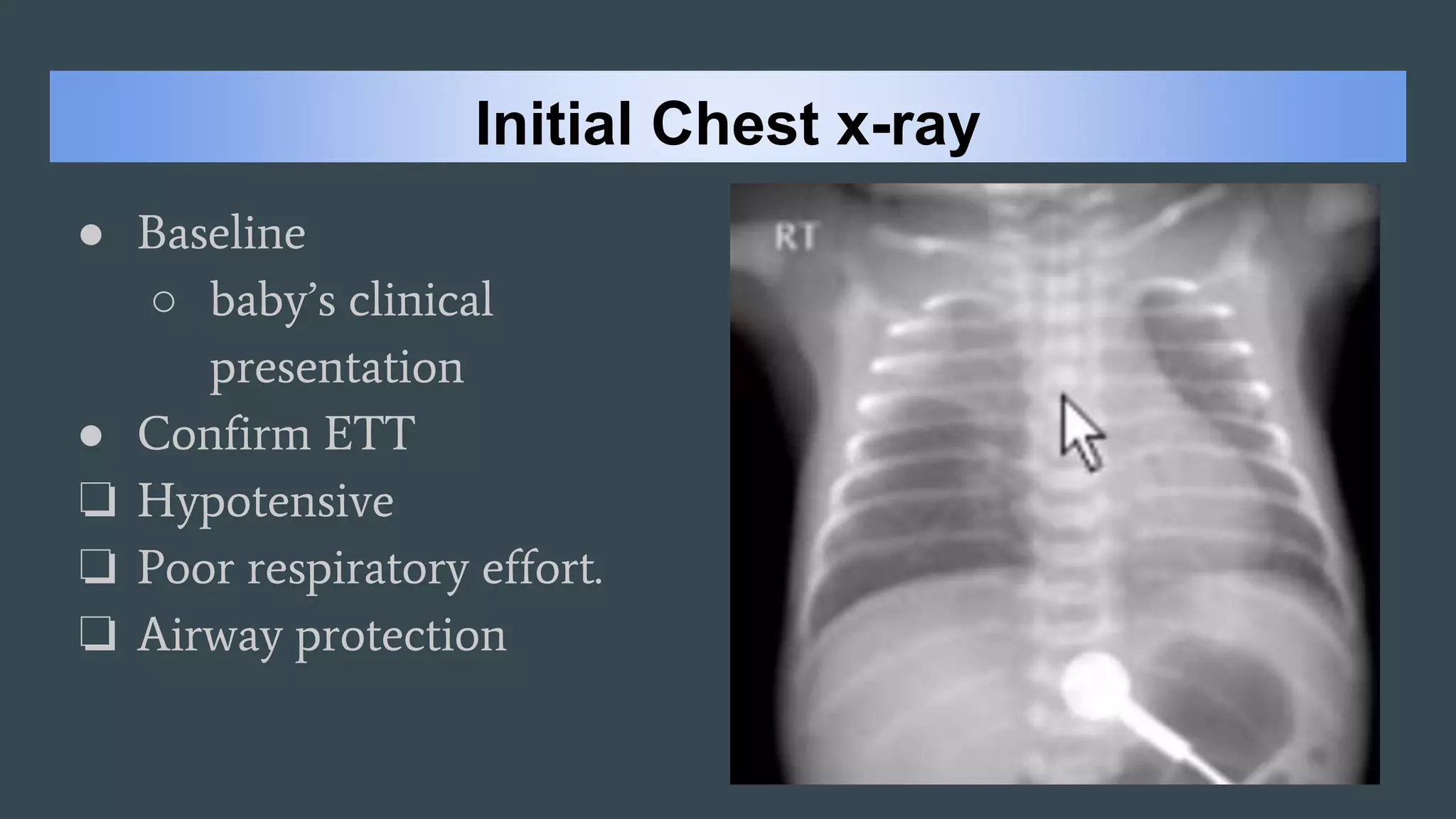 Infant respiratory distress syndrome PPV guideline