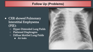 Infant respiratory distress syndrome PPV guideline