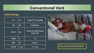 Infant respiratory distress syndrome PPV guideline
