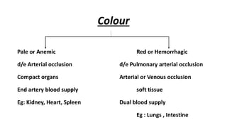 Pale Infarct Kidney