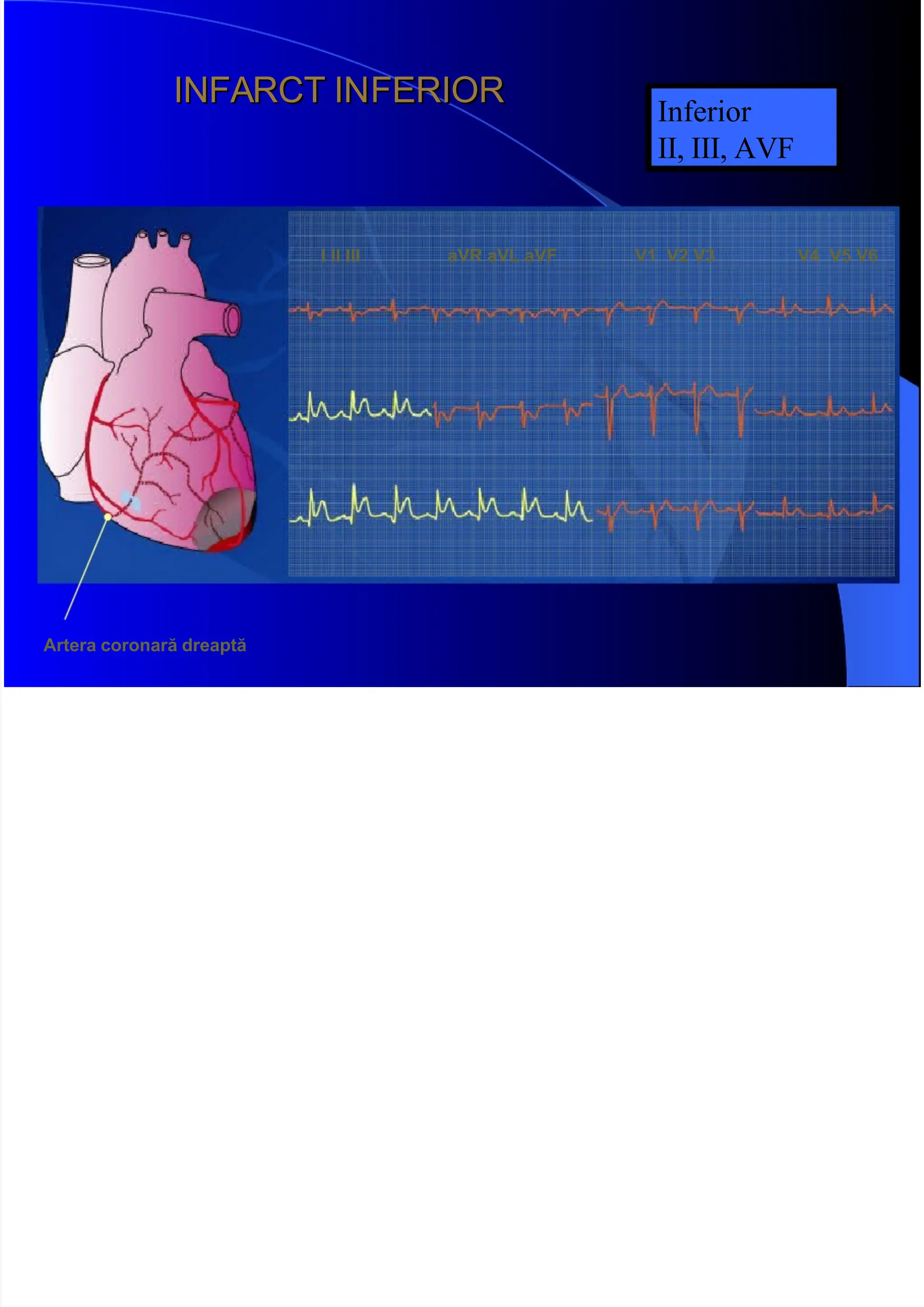 infarct-miocardic-acut.pdf prezentare cu imagini | PDF