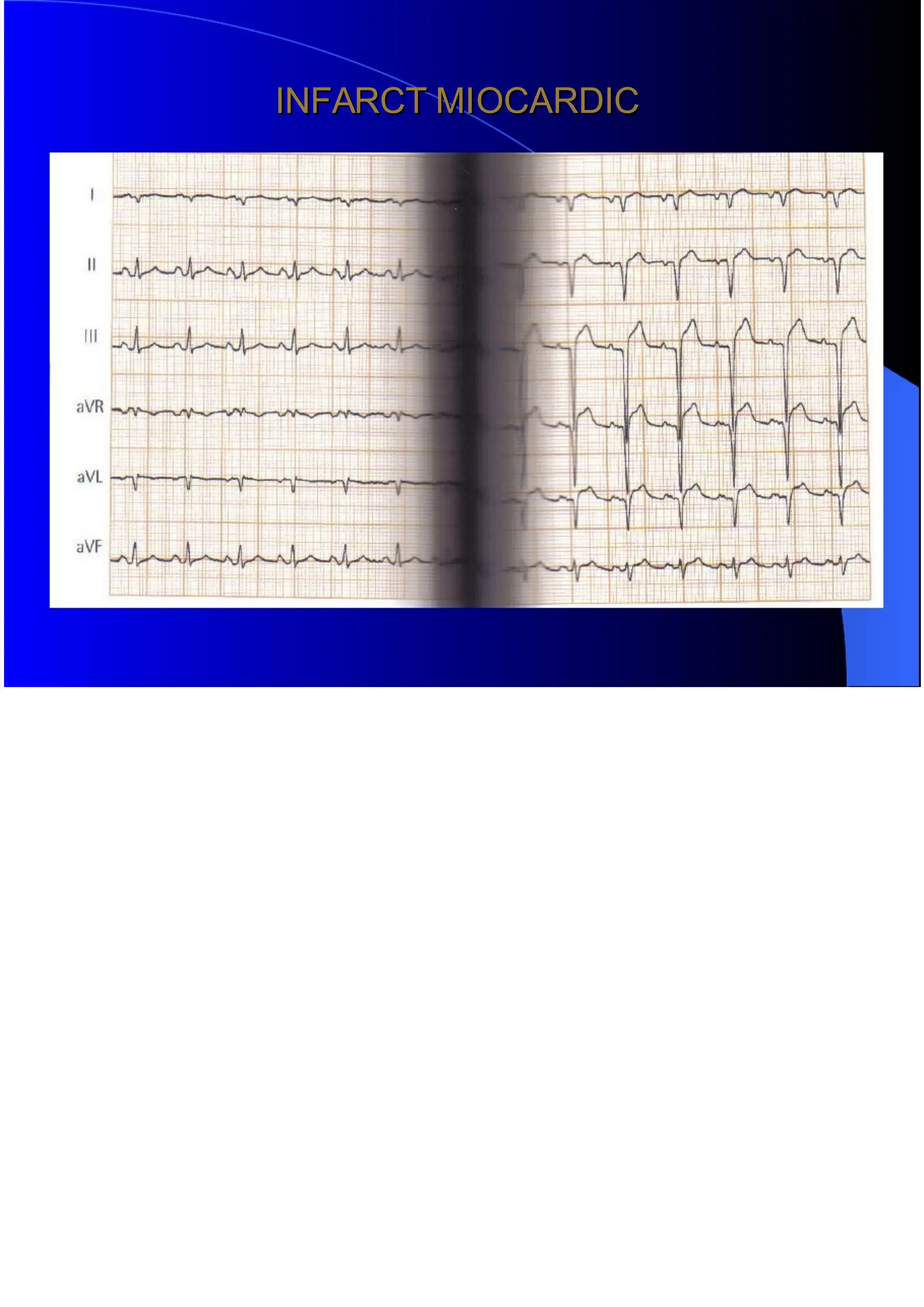 infarct-miocardic-acut.pdf prezentare cu imagini | PDF