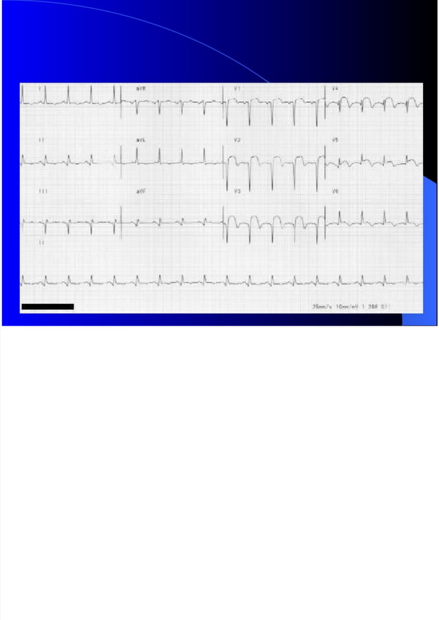 infarct-miocardic-acut.pdf prezentare cu imagini | PDF