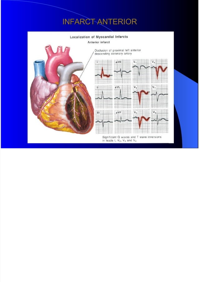 infarct-miocardic-acut.pdf prezentare cu imagini | PDF