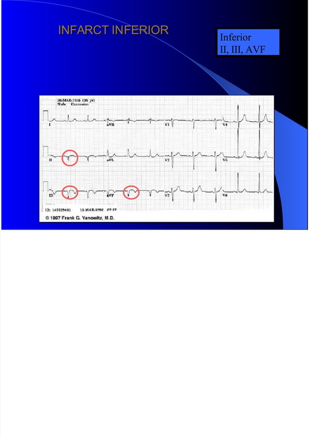 infarct-miocardic-acut.pdf prezentare cu imagini | PDF