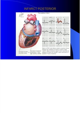 infarct-miocardic-acut.pdf prezentare cu imagini | PDF