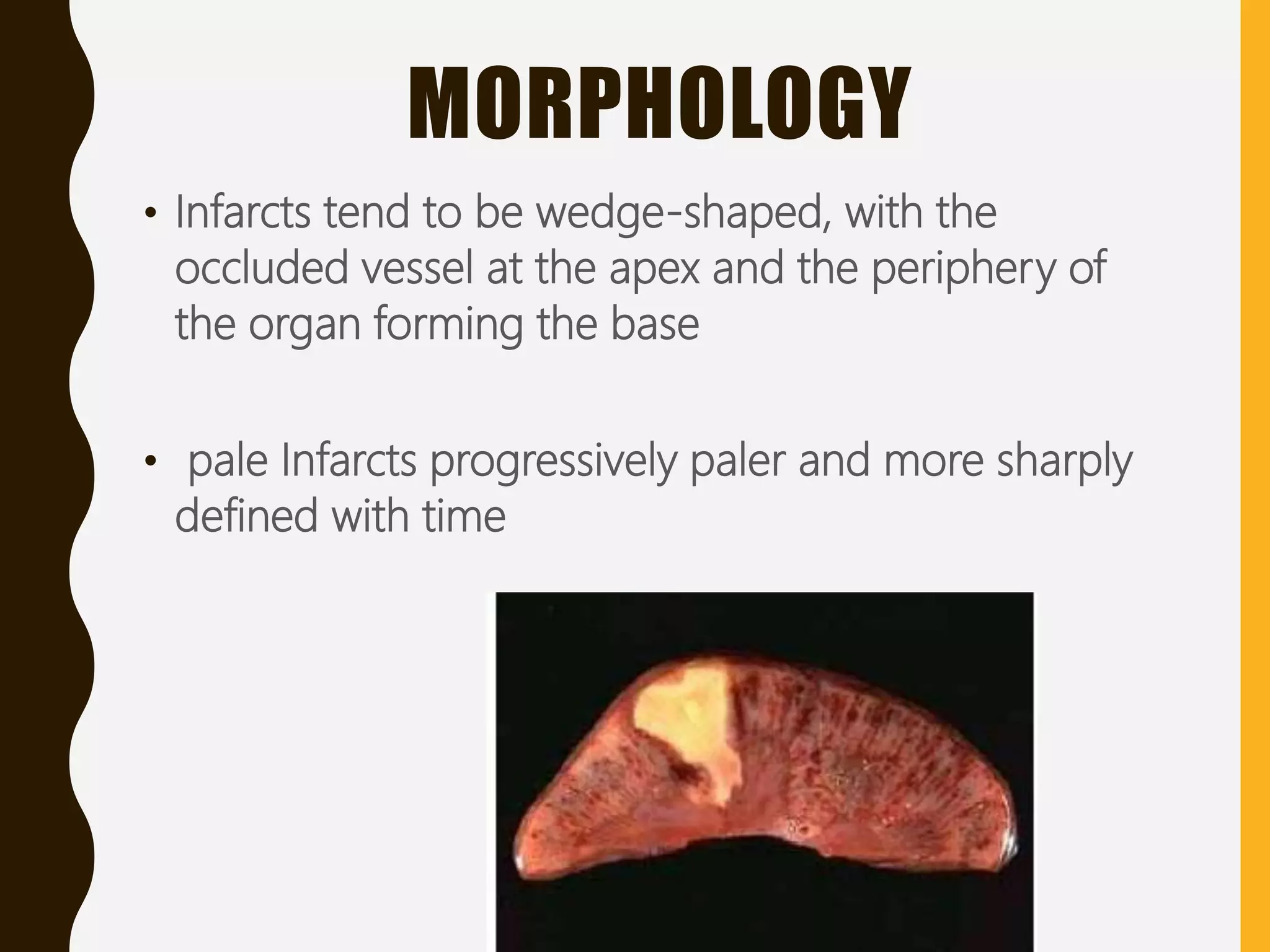 Infarction | PPTX