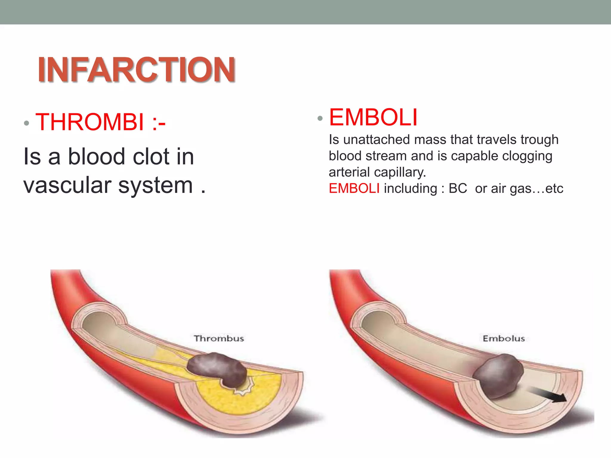 INFARCTION | PDF