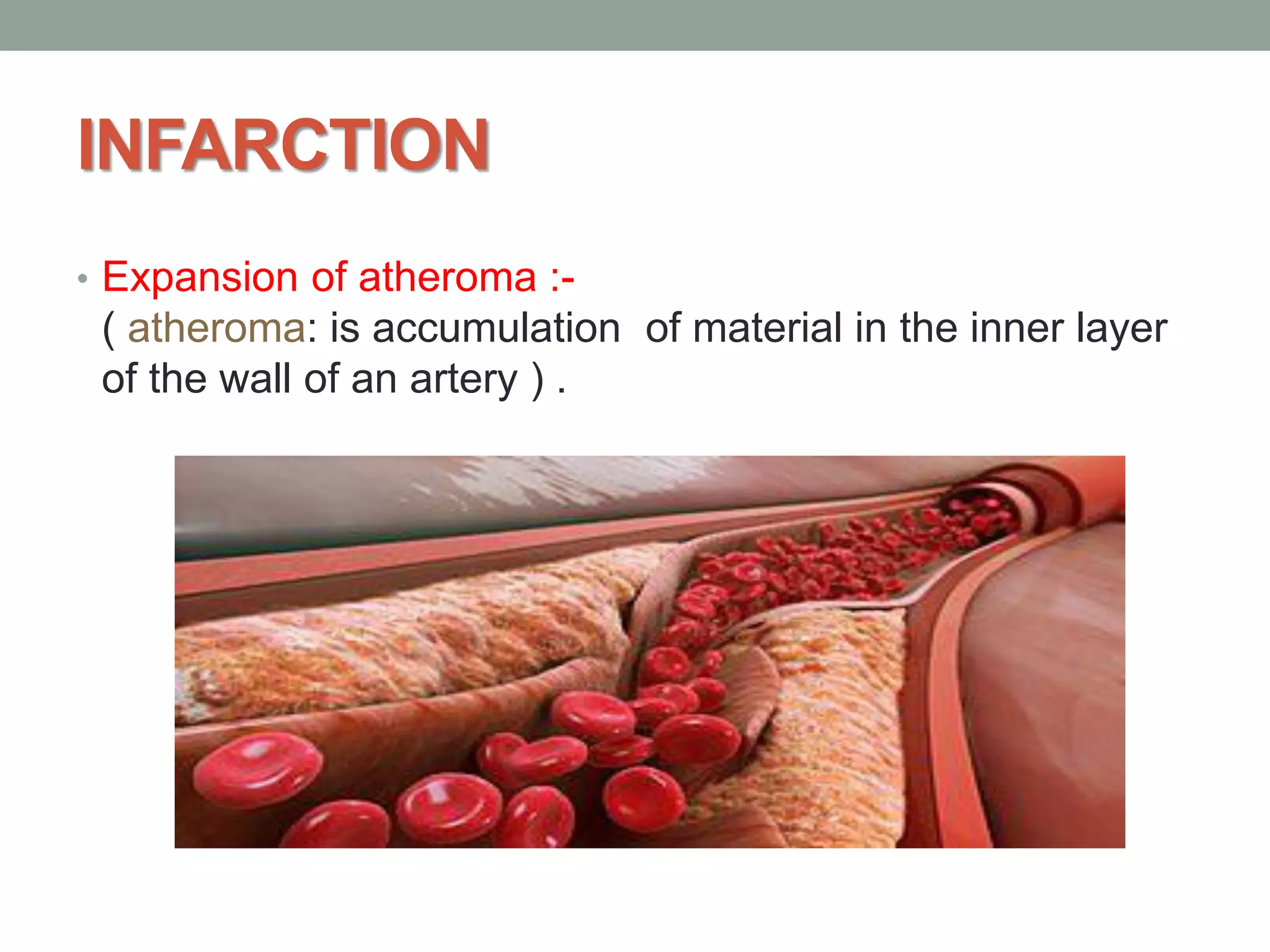 INFARCTION | PDF
