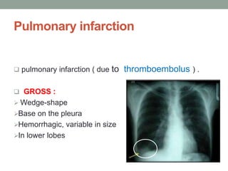 INFARCTION | PDF