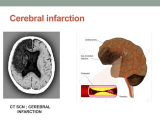 INFARCTION | PDF