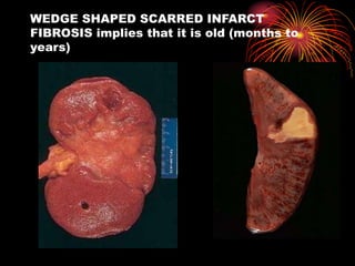 Infarction | PPT | Heart and Cardiovascular Diseases | Diseases and ...