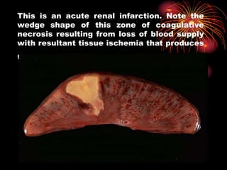 Infarction | PPT | Heart and Cardiovascular Diseases | Diseases and ...