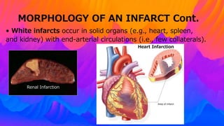 Infarction | PPTX
