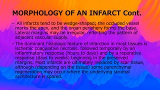 Infarction | PPTX