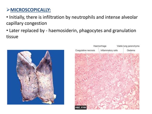 INFARCTION pathology medical students h | PPTX | Blood Disorders ...
