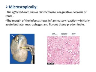 INFARCTION pathology medical students h | PPTX