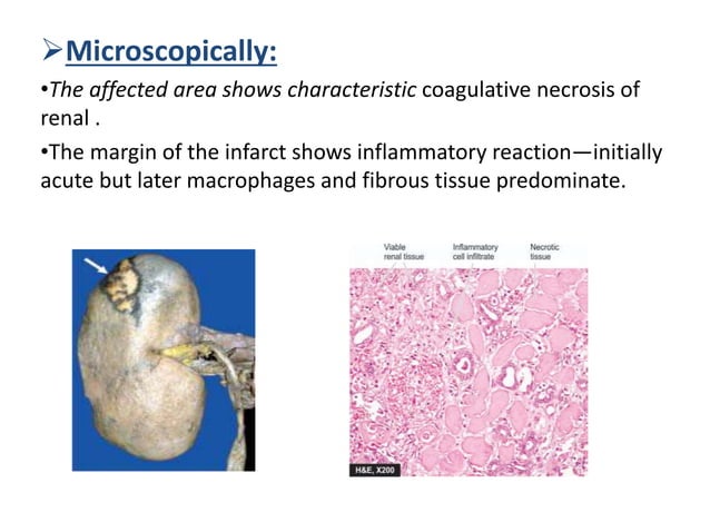 INFARCTION pathology medical students h | PPT