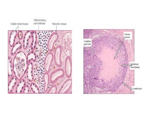 INFARCTION pathology medical students h | PPTX