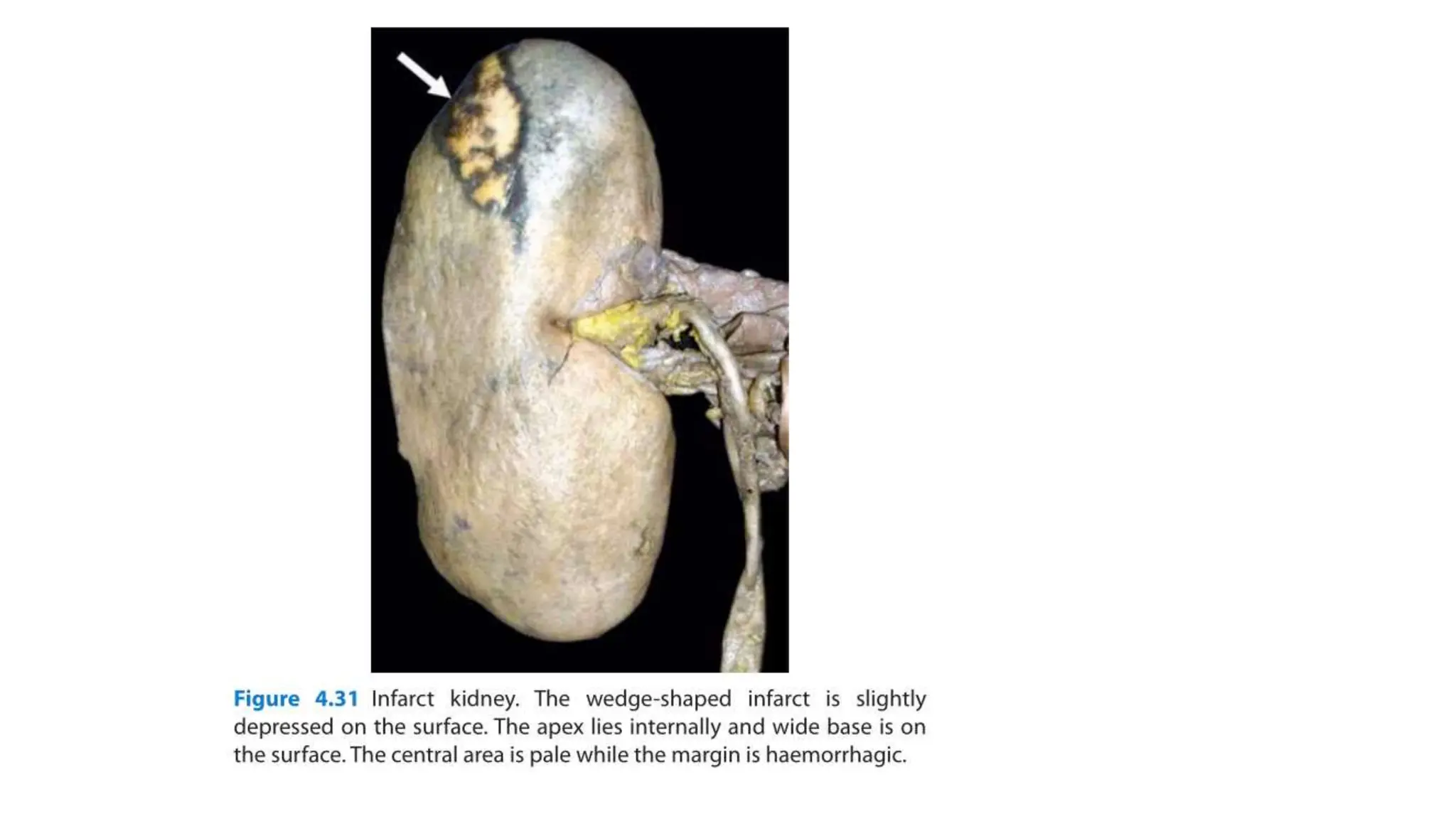 Infarction: types of infarcts, morphology - Pathology - ATOT | PPTX