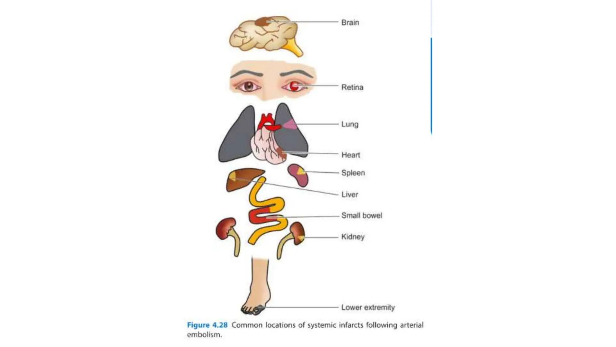 Infarction: types of infarcts, morphology - Pathology - ATOT | PPTX