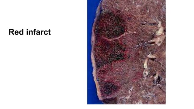 Infarction: types of infarcts, morphology - Pathology - ATOT | PPTX