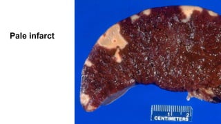 Infarction: types of infarcts, morphology - Pathology - ATOT | PPTX