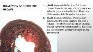 INFARCTION. . | PPT