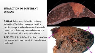 INFARCTION. . | PPT