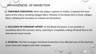 INFARCTION. . | PPT