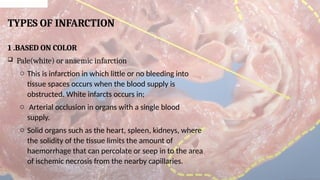 INFARCTION. . | PPT
