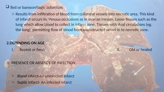 INFARCTION. . | PPT