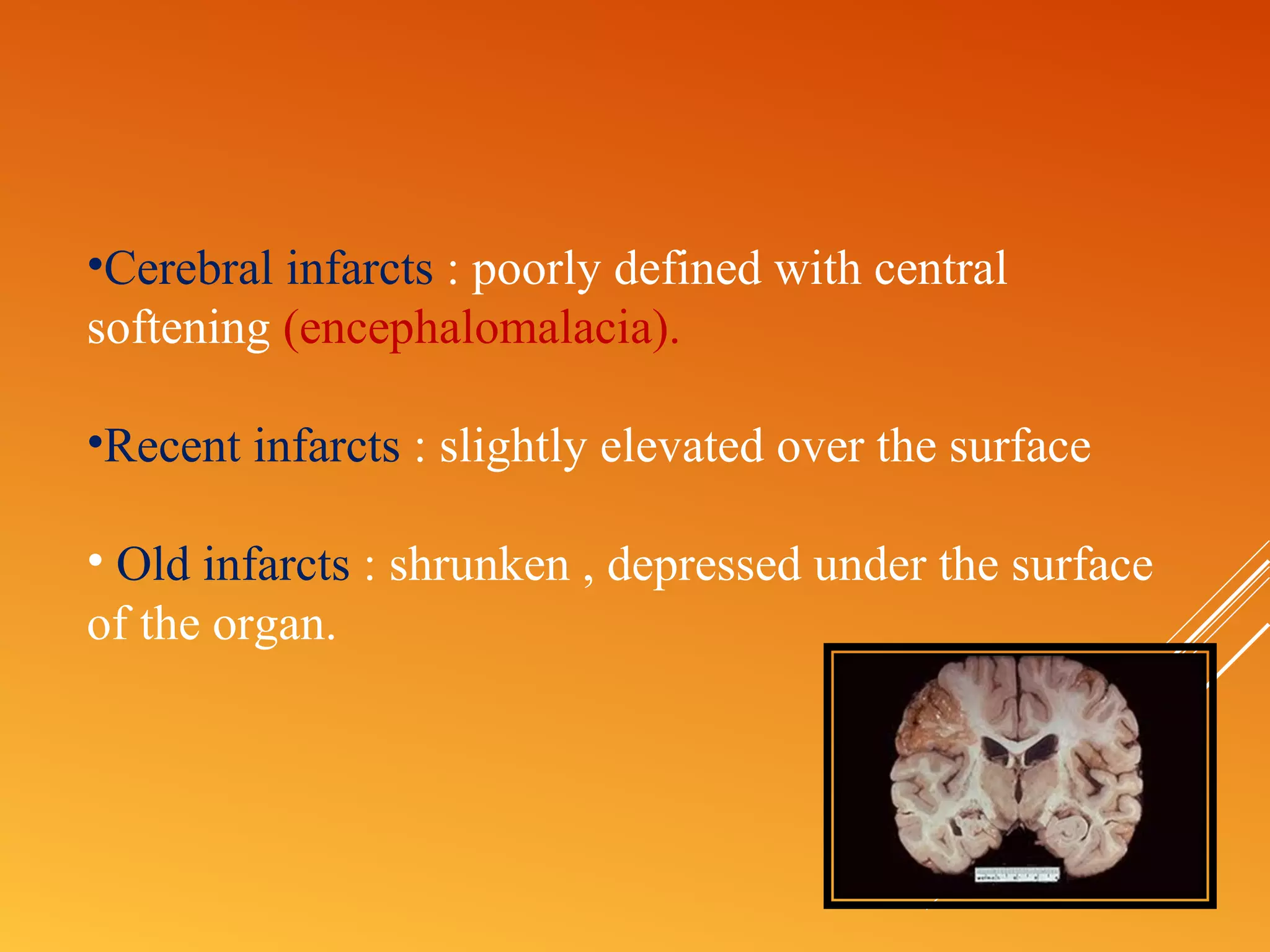 Infarction | PPT