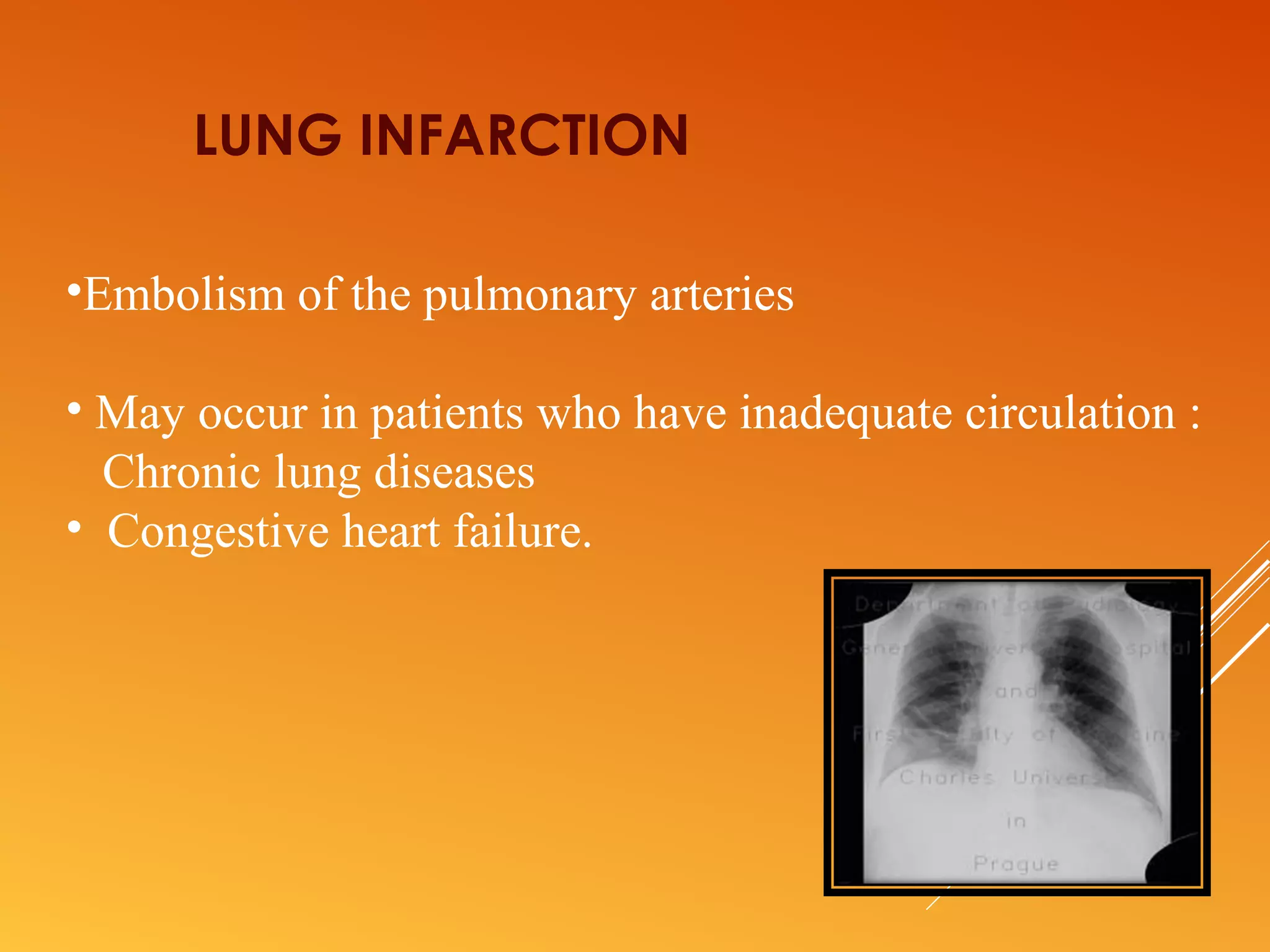 Infarction | PPT