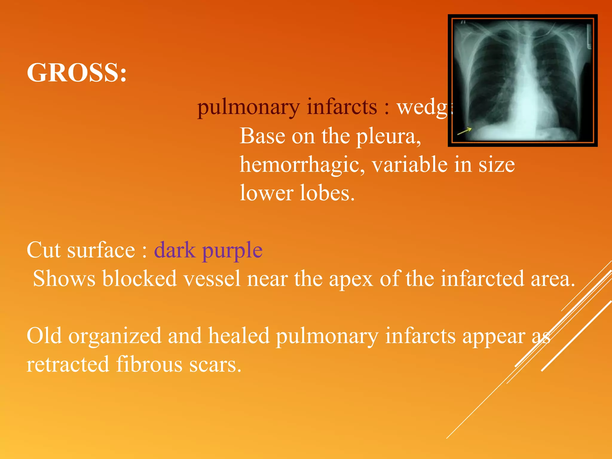 Infarction | PPT