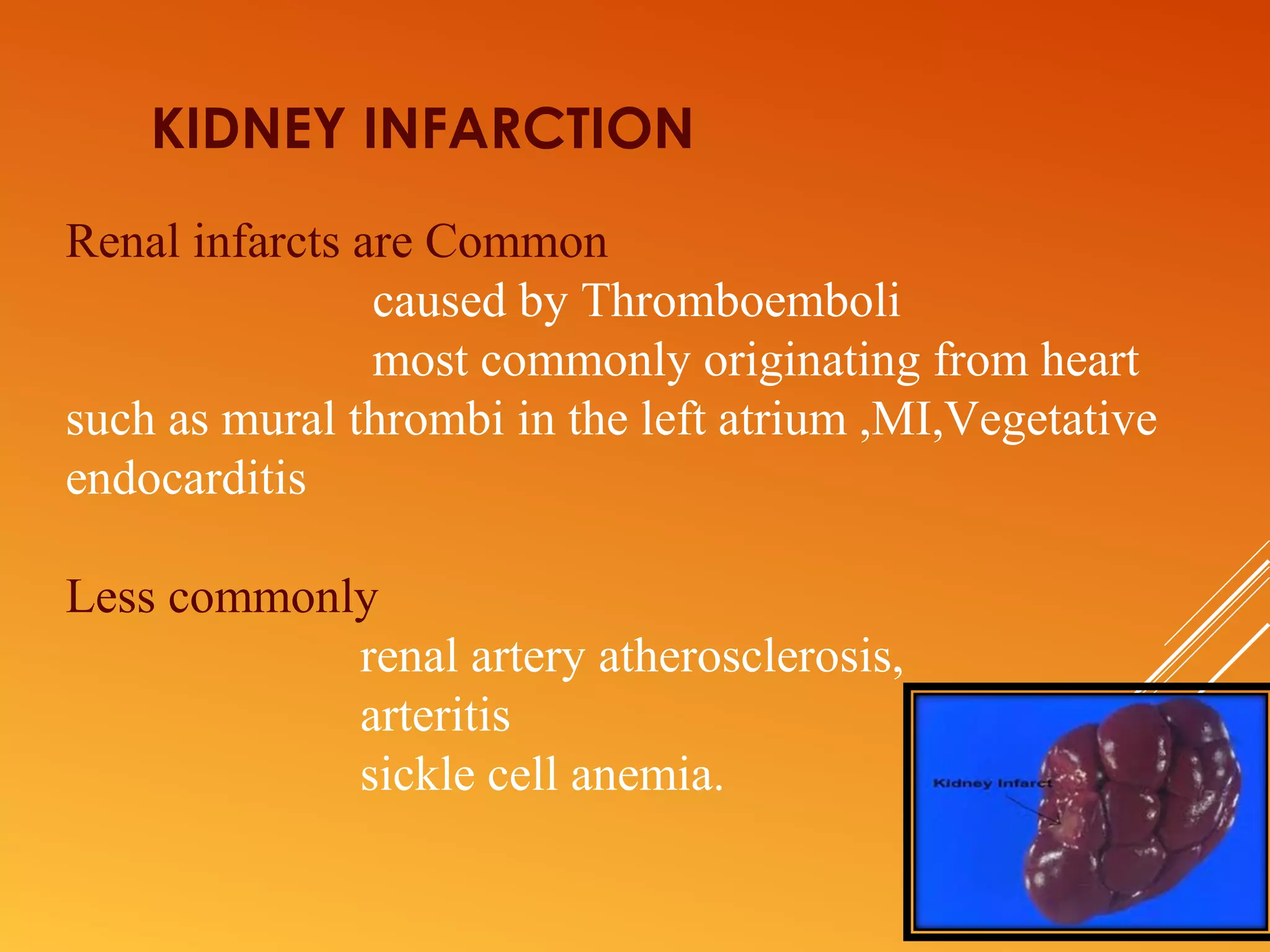 Infarction | PPT
