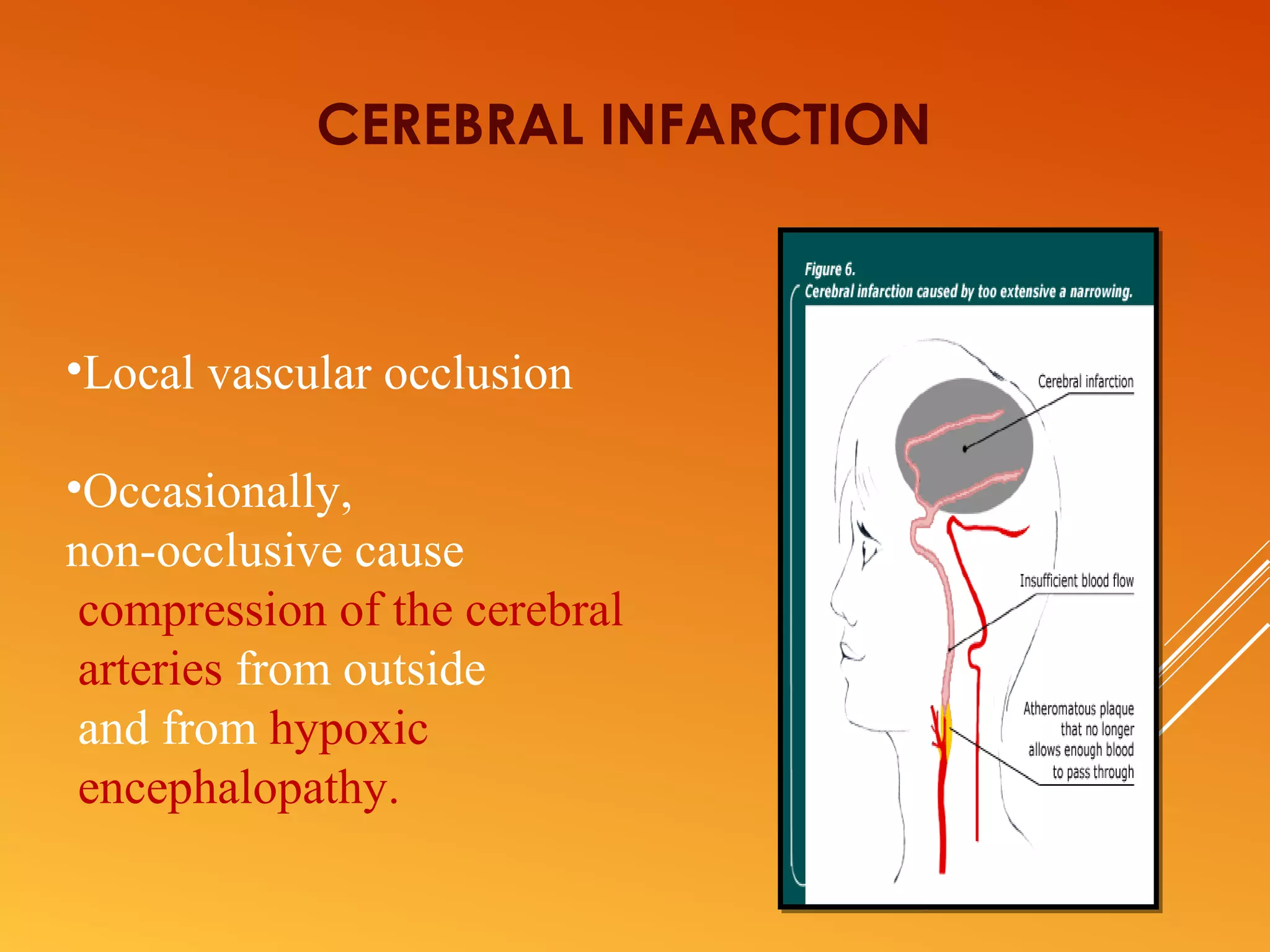 Infarction | PPT